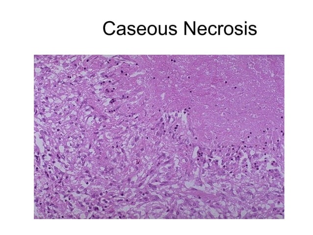 5. Necrosis.ppt 6877987969879877987987878 | PPT