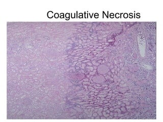 5. Necrosis.ppt 6877987969879877987987878 | PPT