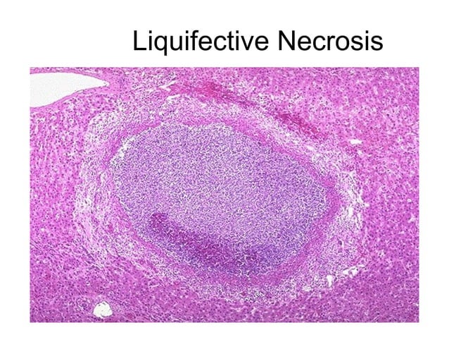 5. Necrosis.ppt 6877987969879877987987878 | PPT