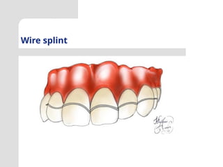 5. immobilization. dental traumatologypptx | PPT