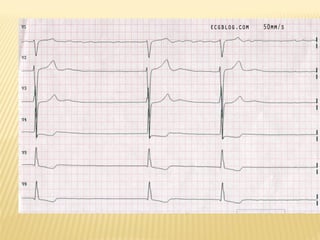GAMBARAN EKG DASAR, EKG LAIN SESUAIKAN.. | PDF