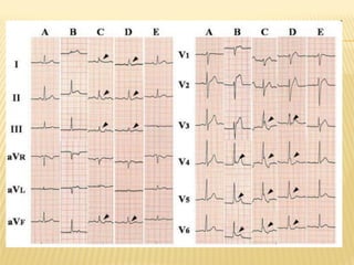 GAMBARAN EKG DASAR, EKG LAIN SESUAIKAN.. | PDF