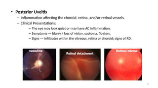 5.opththalmology Uveitis.over view pptx | PPT