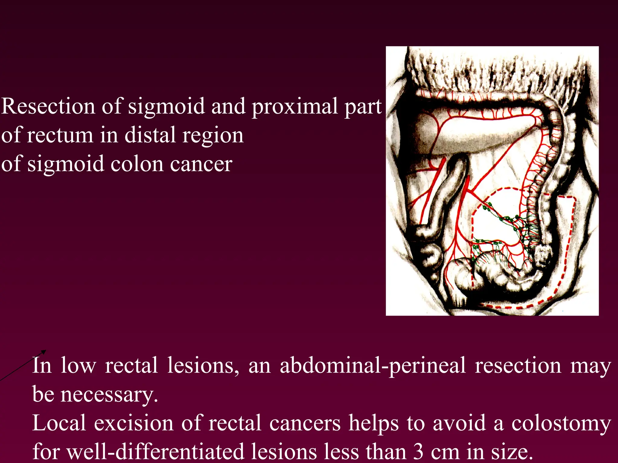 Colorectal cancer in details cfu univ.ppt