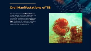 Exploring the manifestations of tuberculosis in clinival and dental ...