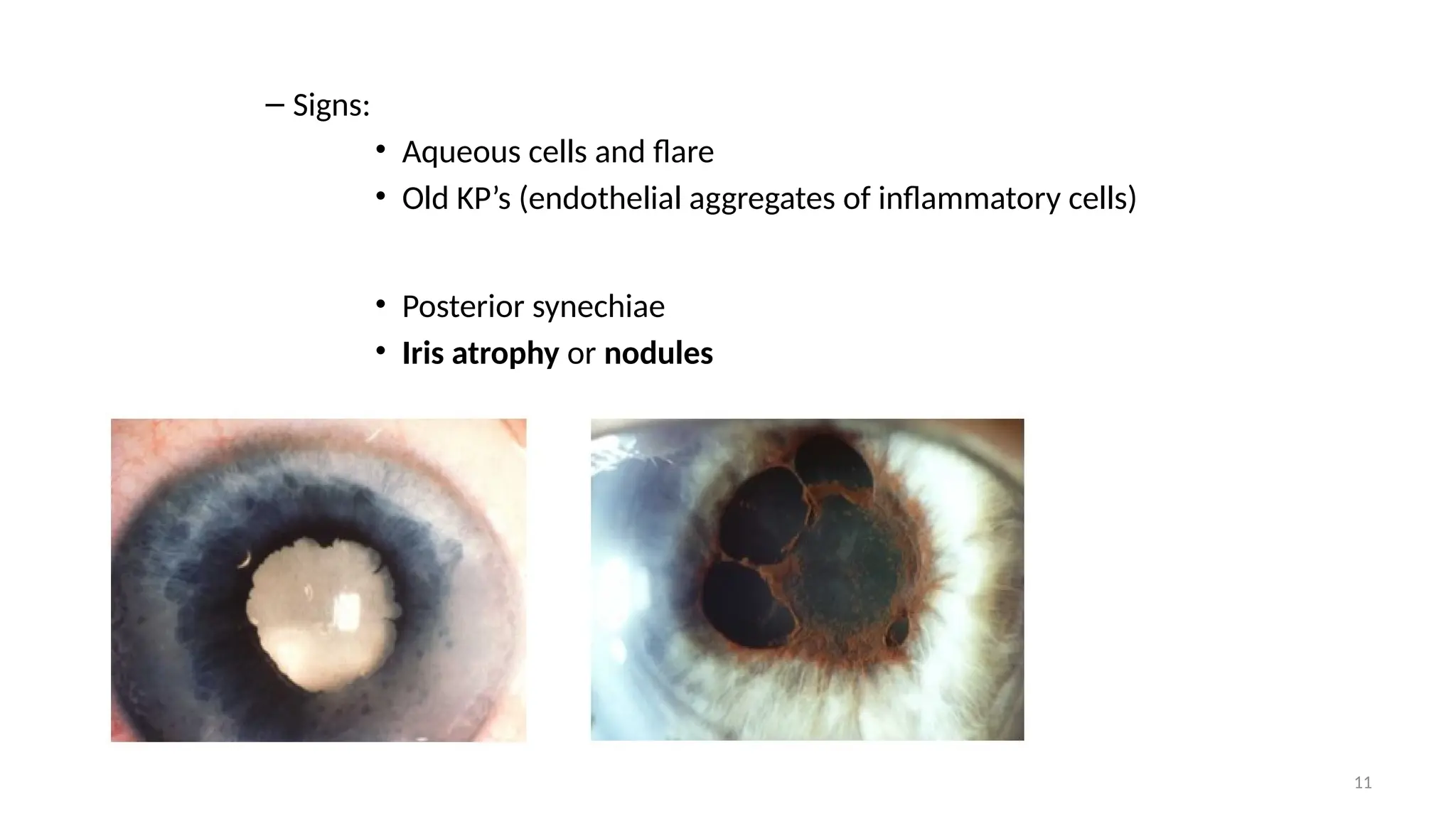 5. Uveitis (2) (3) presentation of .pptx