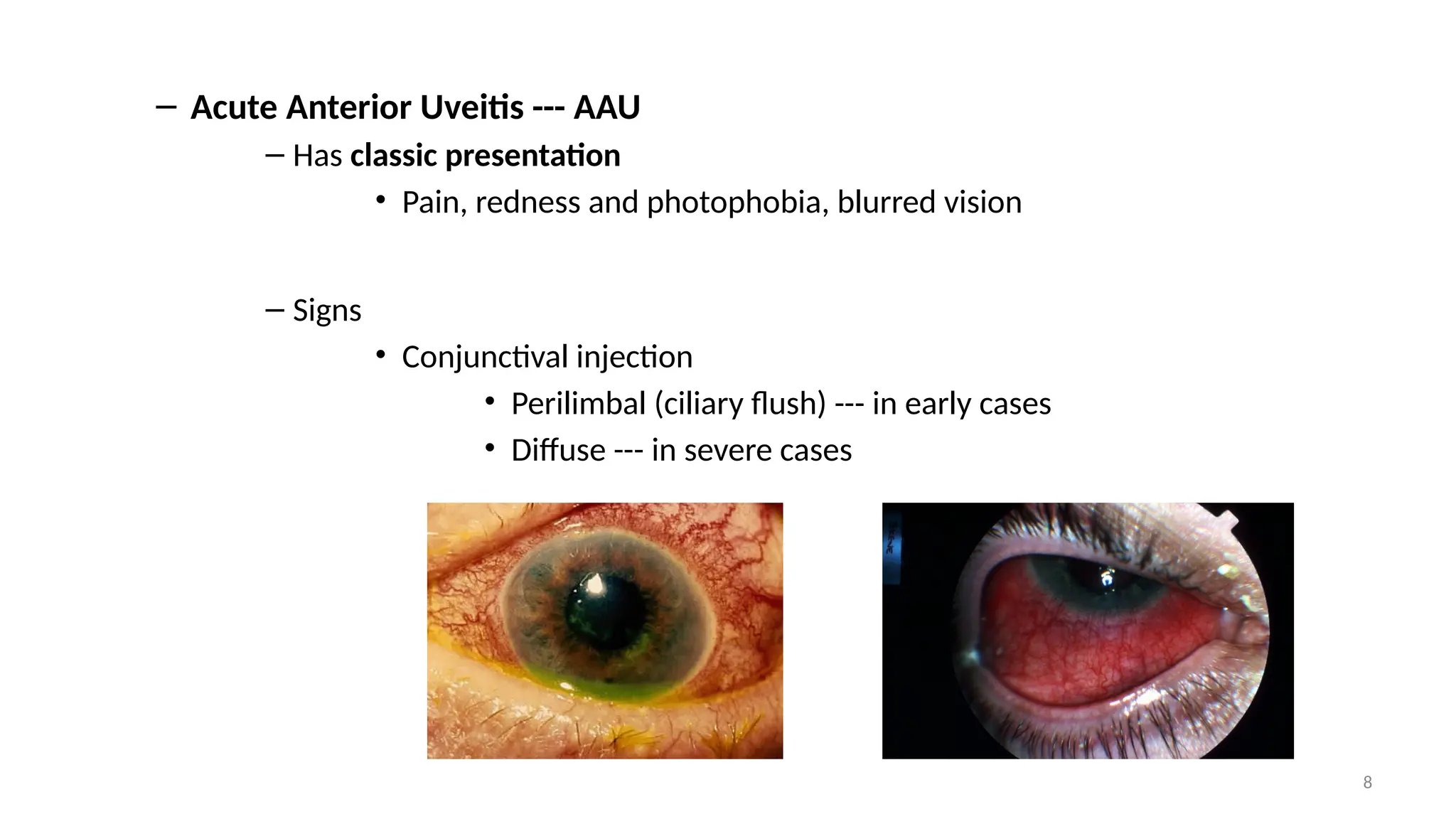5. Uveitis (2) (3) presentation of .pptx