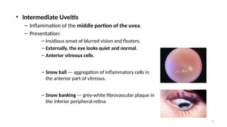 5. Uveitis (2) (3) presentation of .pptx
