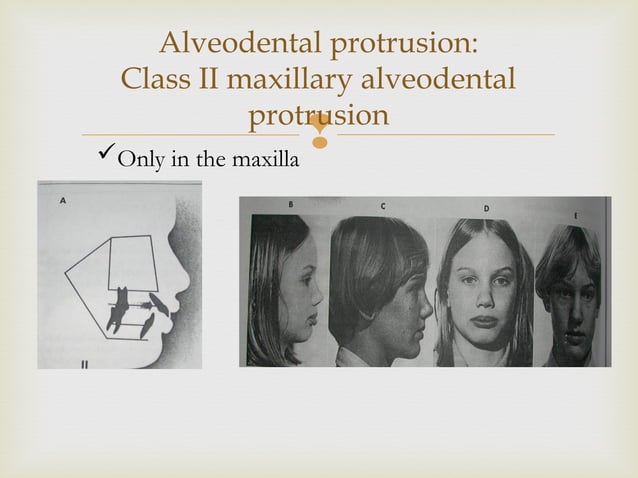 5.SERIAL EXTRACTION.ppt lecture class.ppt