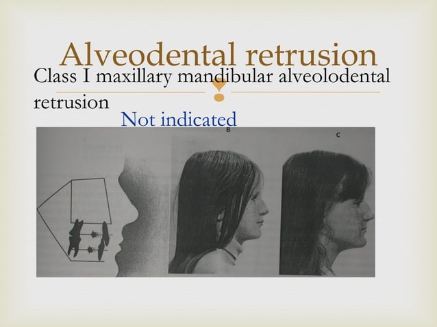 5.SERIAL EXTRACTION.ppt lecture class.ppt