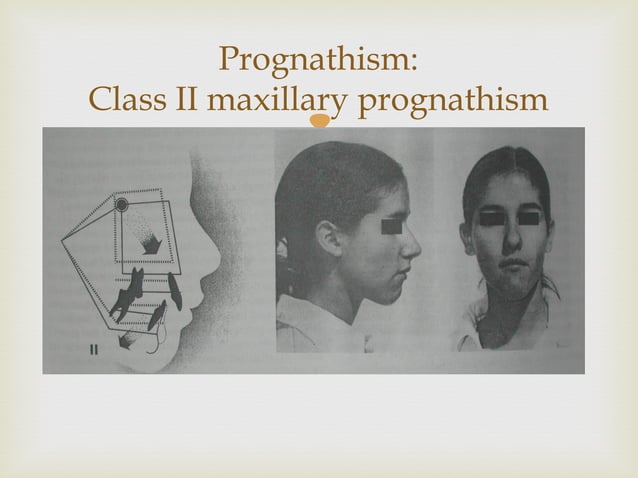 5.SERIAL EXTRACTION.ppt lecture class.ppt