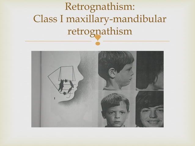 5.SERIAL EXTRACTION.ppt lecture class.ppt