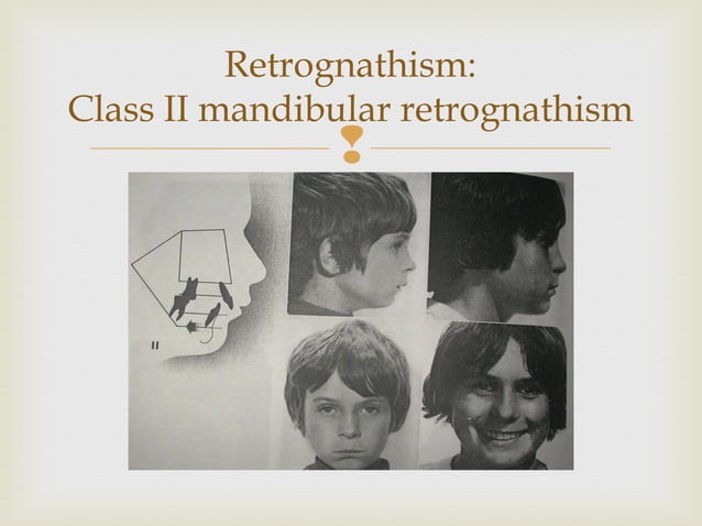 5.SERIAL EXTRACTION.ppt lecture class.ppt