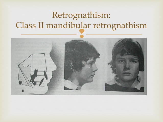 5.SERIAL EXTRACTION.ppt lecture class.ppt