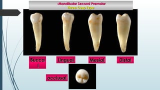 5. Lec CONS Mandibular second premolar.ppt