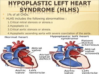 5.HLHS, truncus arteriosus, TOTAL ANOMALOUS pulmonary vessels-.ppt
