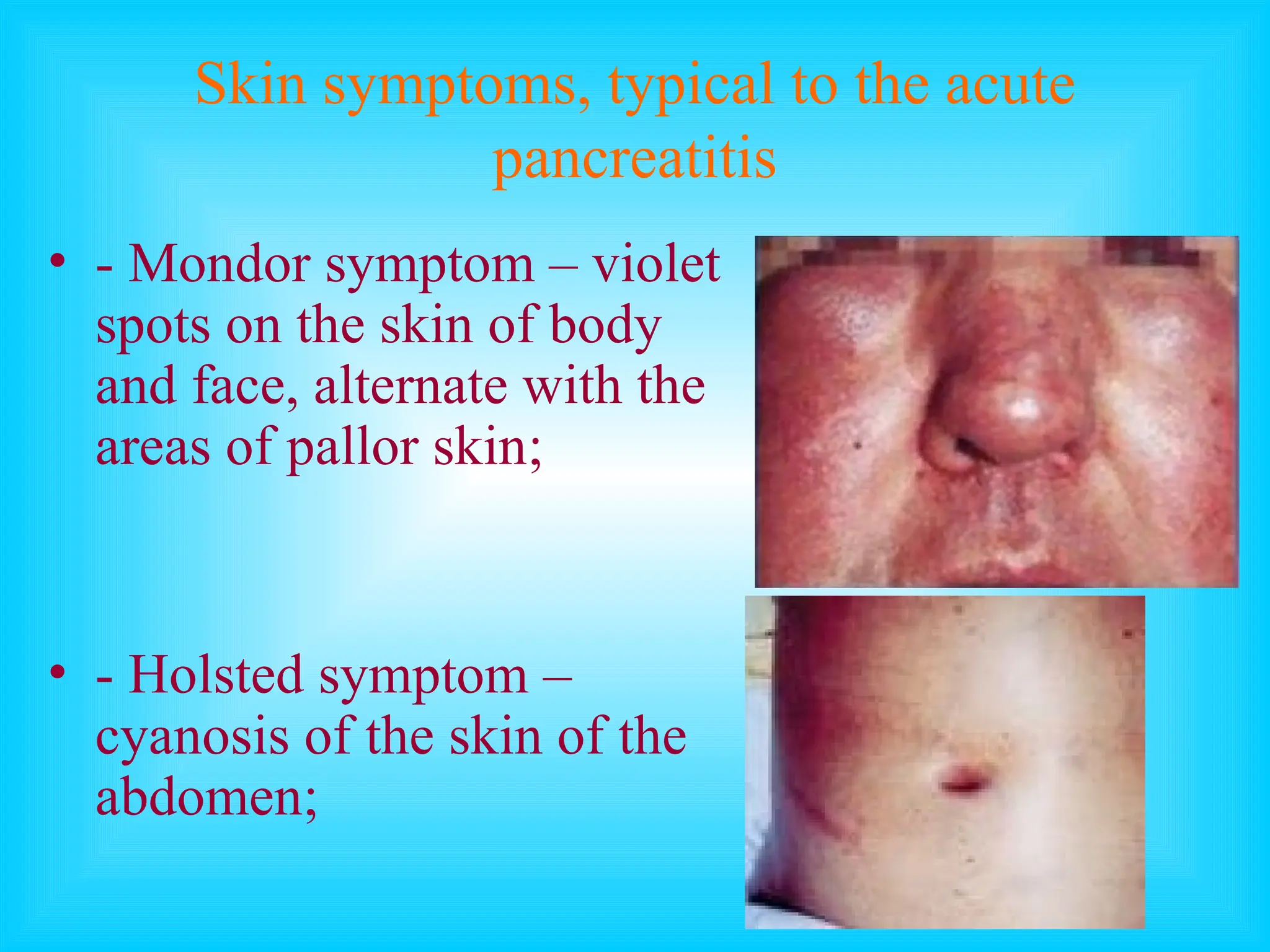 Acute pancreatitis is a sudden inflammation of the pancreas due to ...