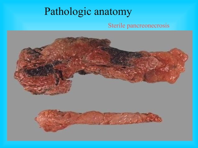 Acute pancreatitis is a sudden inflammation of the pancreas due to ...