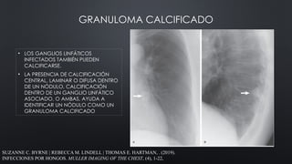 5. Tuberculosis, histoplasmosis, aspergilosis, coccidiocomicosis Dr ...