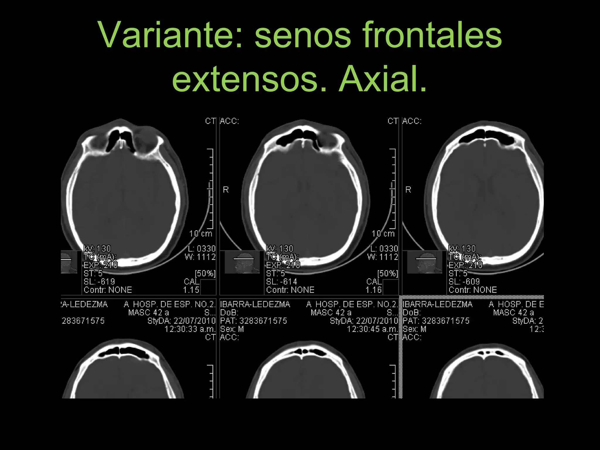 5.3 anatomía seccional de los senos paranasales por tchm | PDF