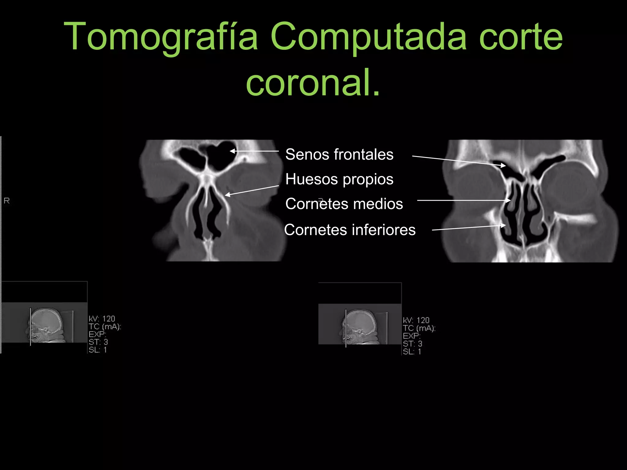 5.3 anatomía seccional de los senos paranasales por tchm | PDF