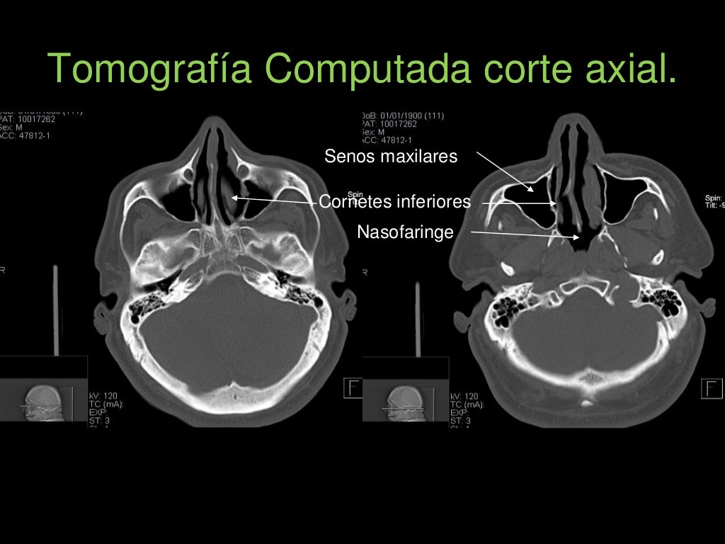 5.3 anatomía seccional de los senos paranasales por tchm