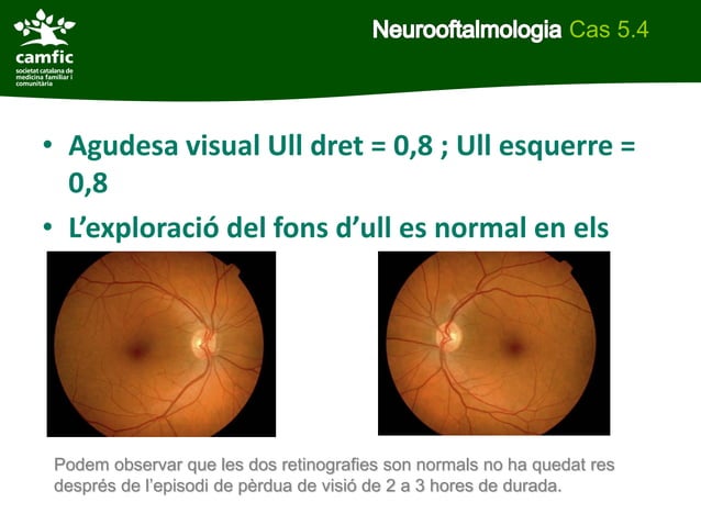 5.4 amaurosis fugax | PDF