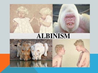 Albinism Ashok D kristu jayanti college | PPT