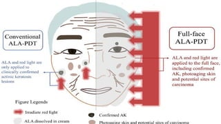 5-aminolevulinic acid (ALA) in Photodynamic therapy (PDT) | PPTX