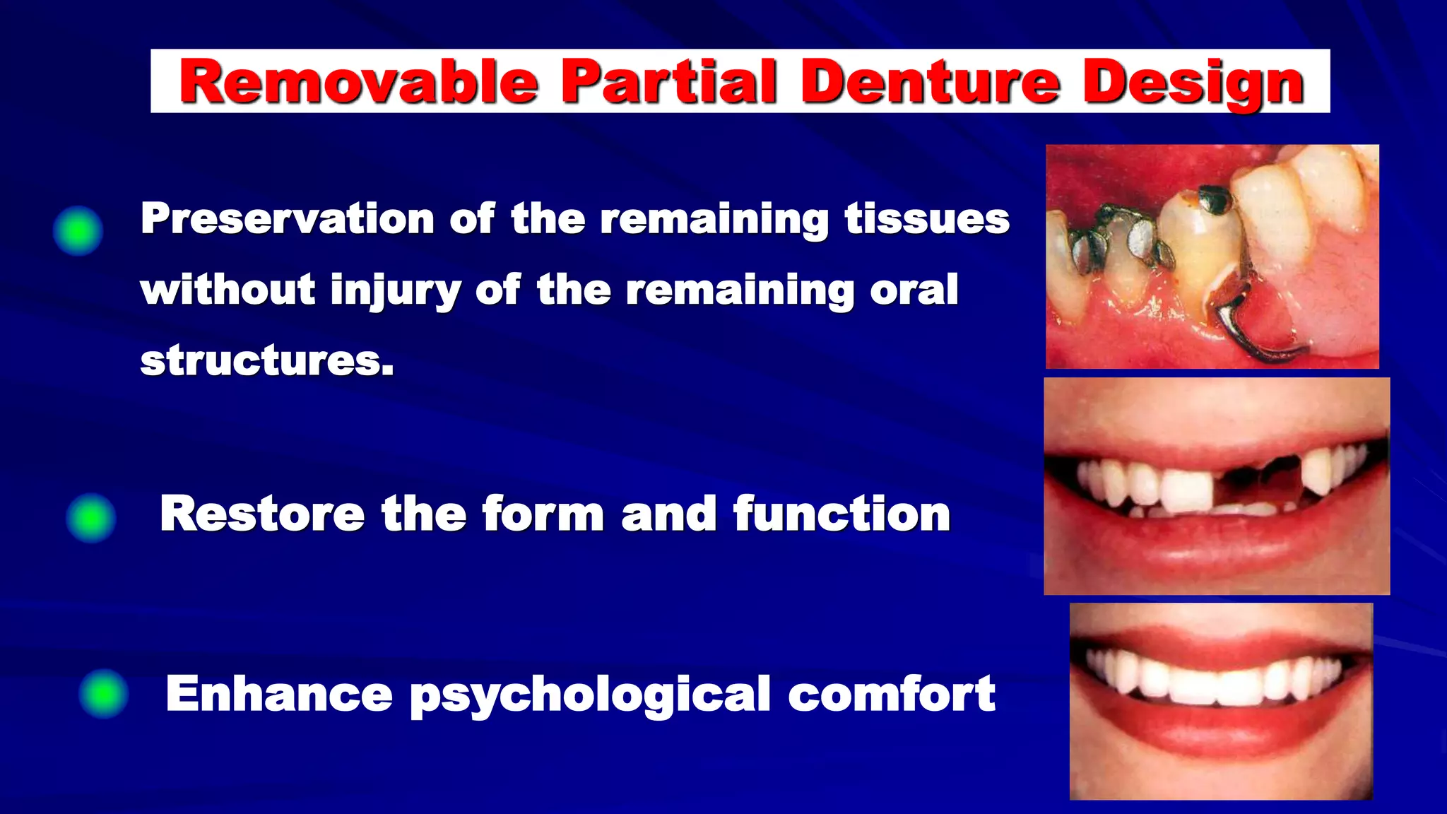 5- Basic principles for designing the removable partial denture class i ...
