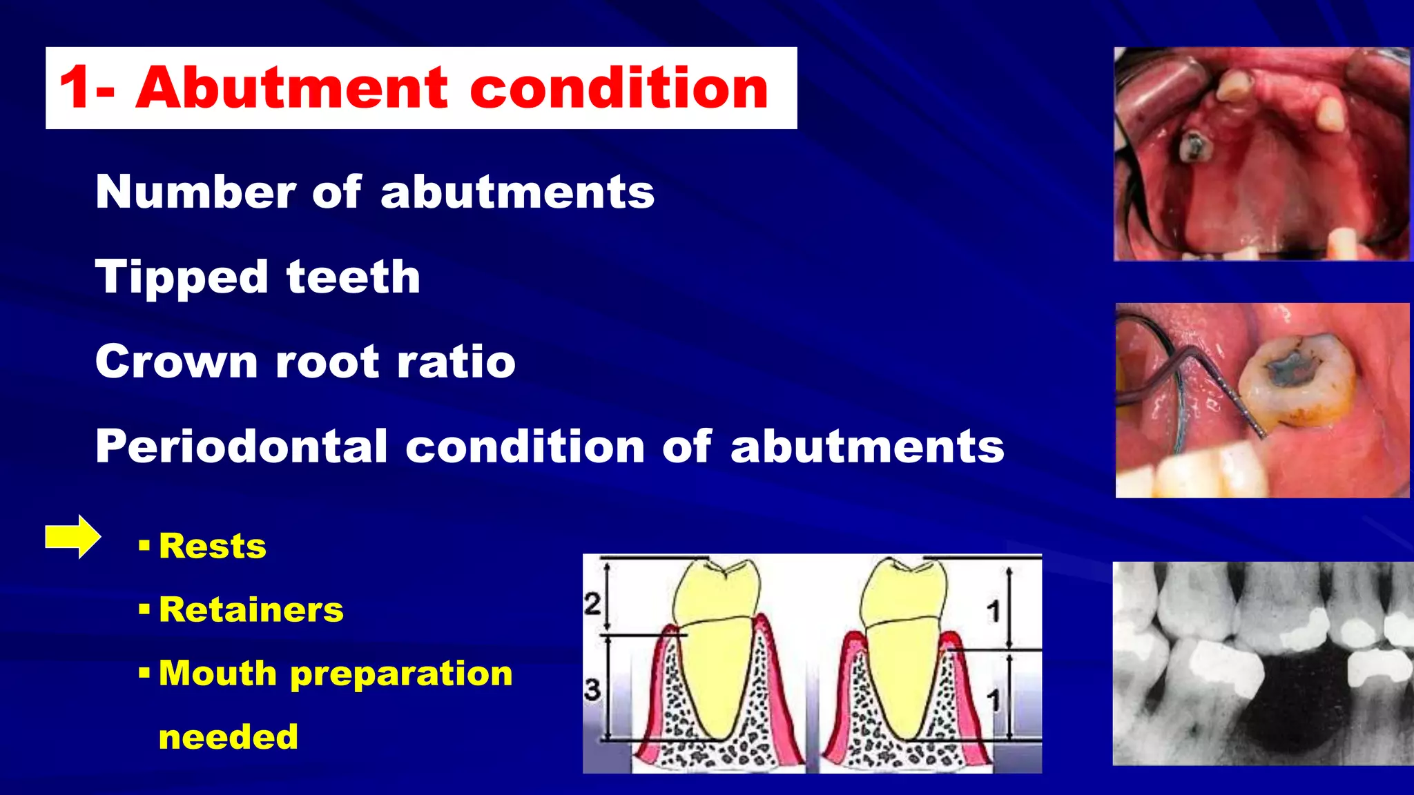 5- Basic principles for designing the removable partial denture class i ...