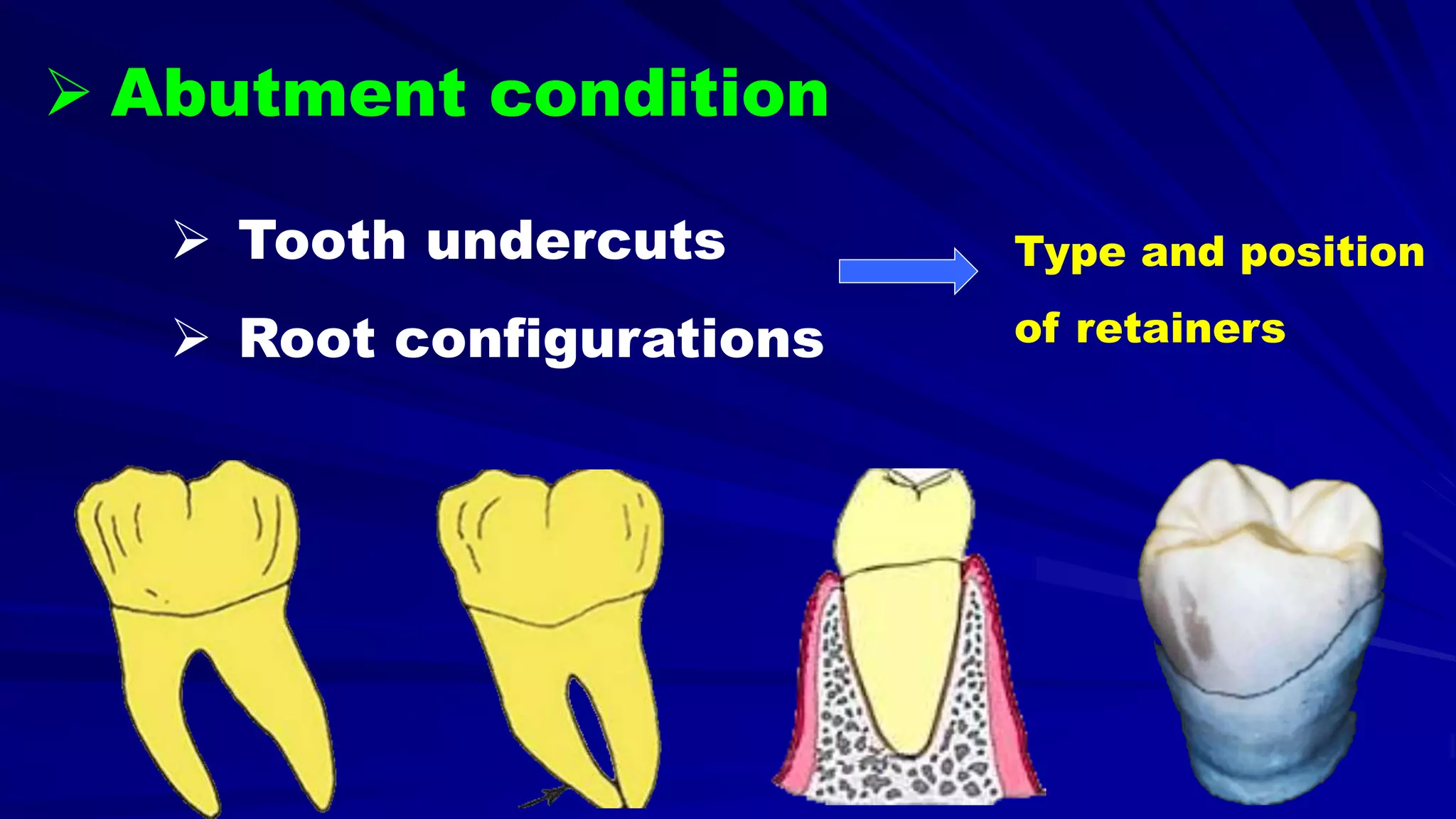 5- Basic principles for designing the removable partial denture class i ...