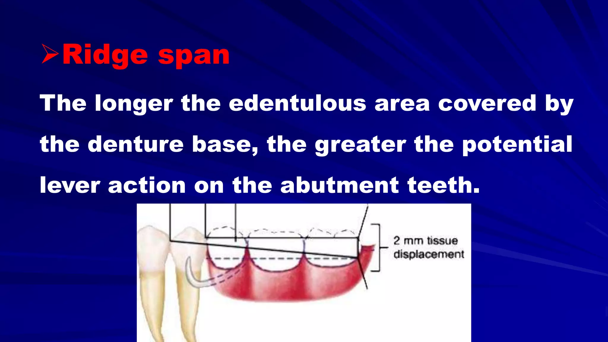 5- Basic principles for designing the removable partial denture class i ...