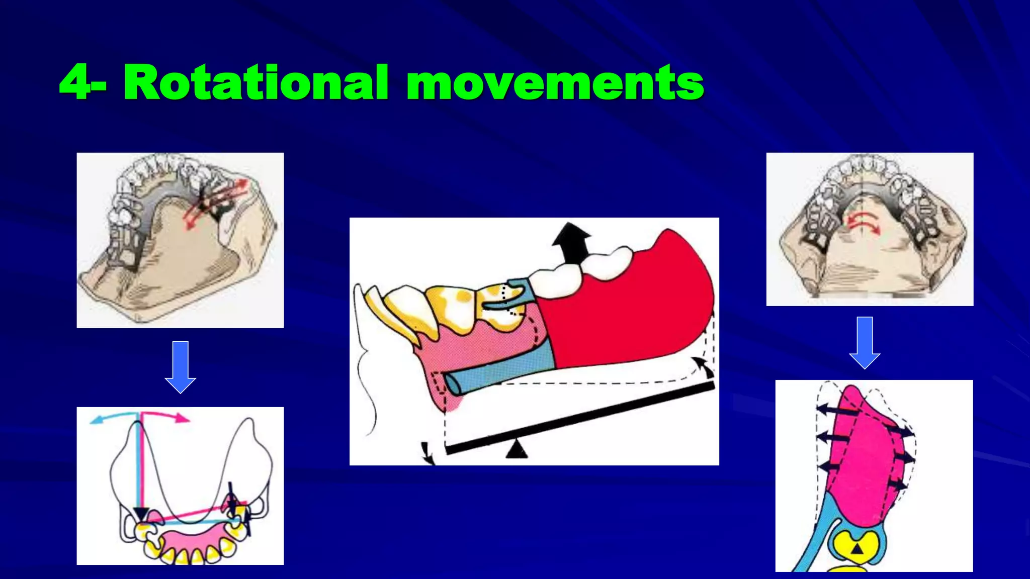 5- Basic principles for designing the removable partial denture class i ...