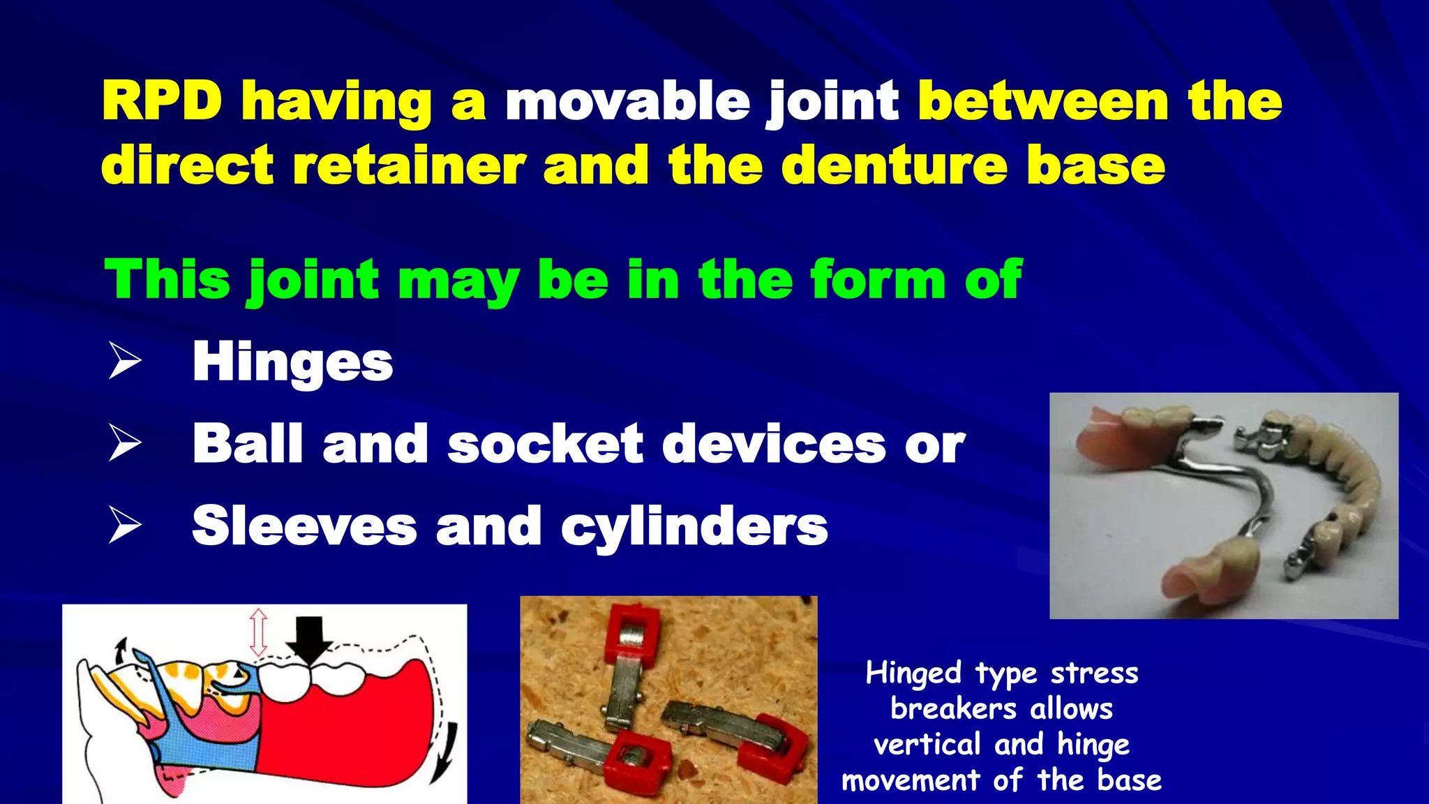 5- Basic principles for designing the removable partial denture class i ...