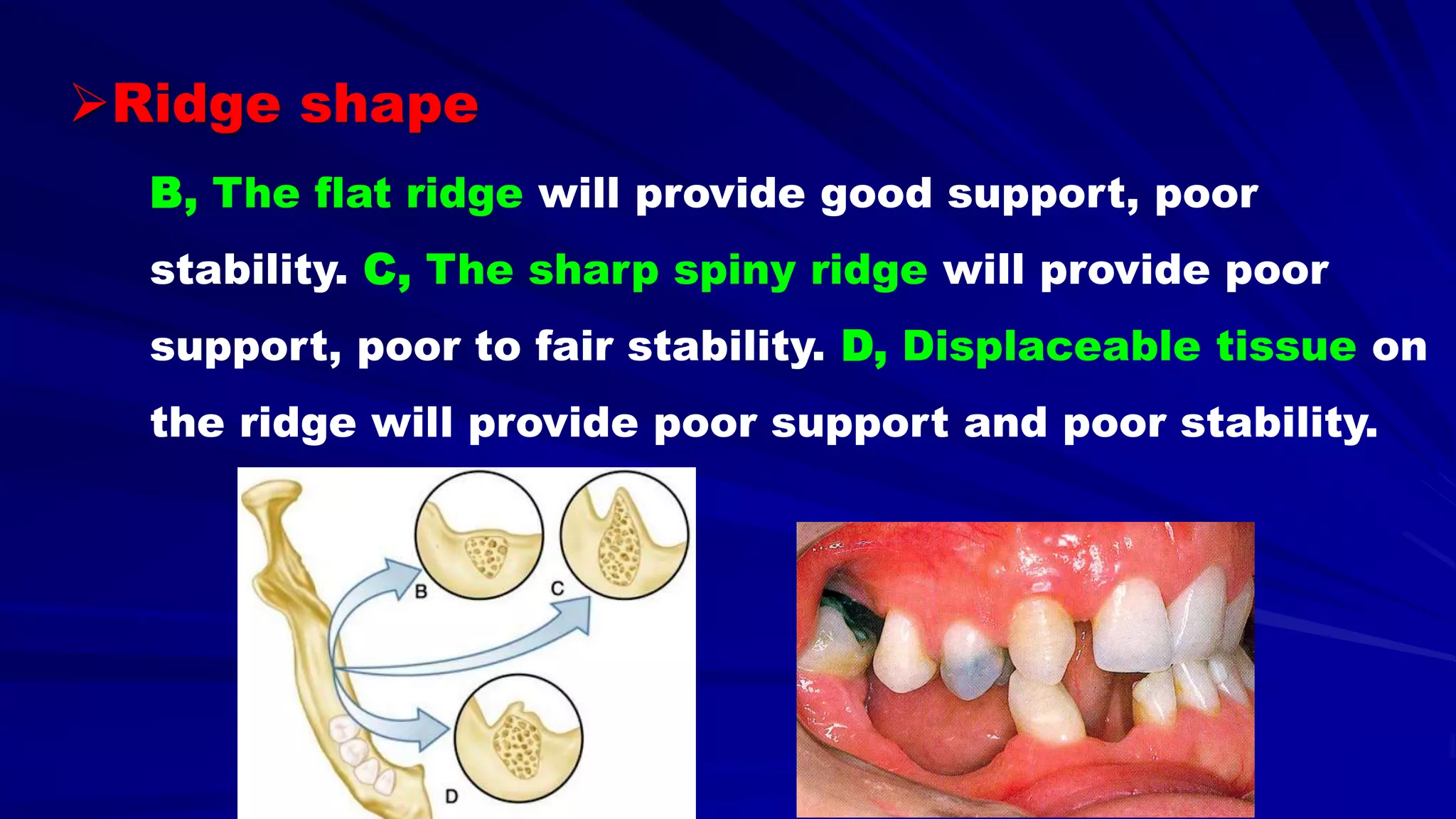 5- Basic principles for designing the removable partial denture (class ...