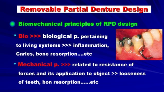 5- Basic principles for designing the removable partial denture (class ...