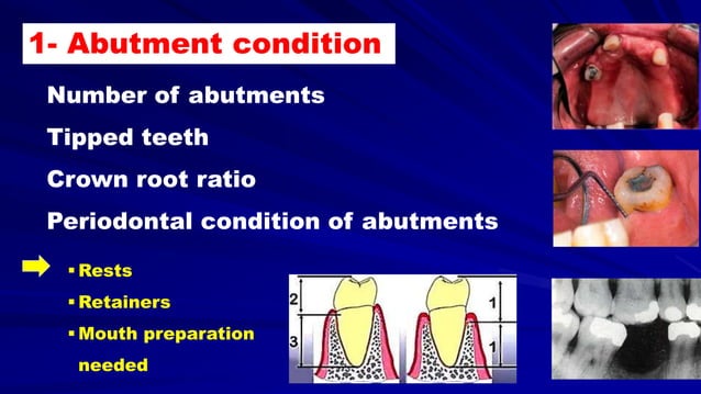 5- Basic principles for designing the removable partial denture (class ...