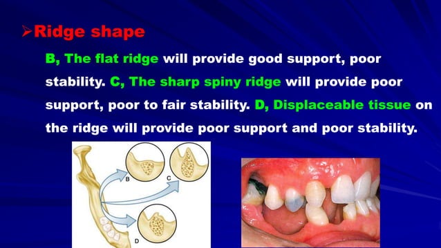 5- Basic principles for designing the removable partial denture (class i partial denture design ...