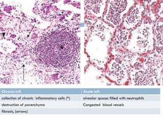 5.chronic inflammation dr ashutosh kumar | PPT