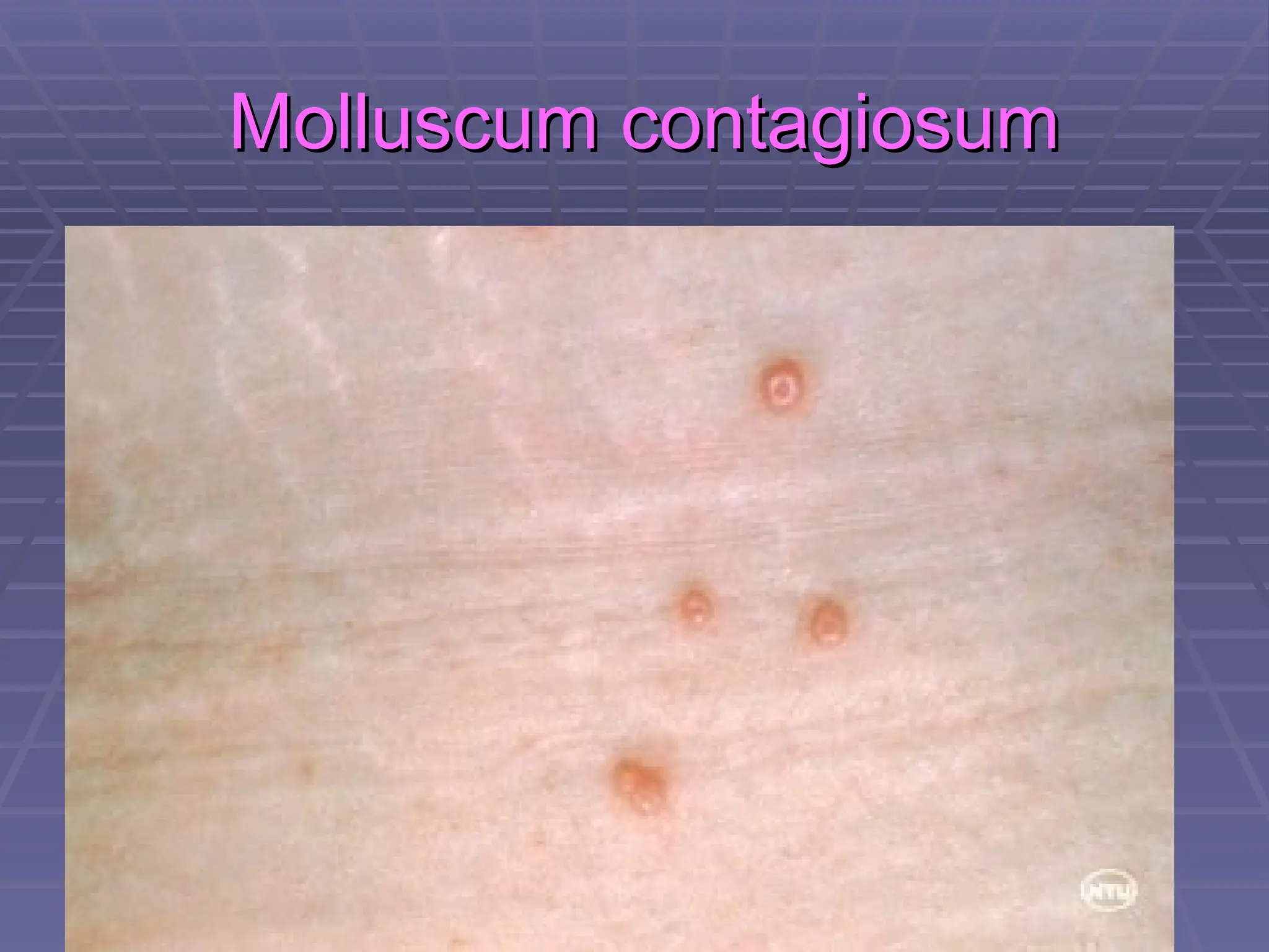 Dermatology - common skin infections by Dr. Eman | PPT