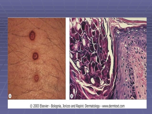 Dermatology - common skin infections by Dr. Eman | PPT