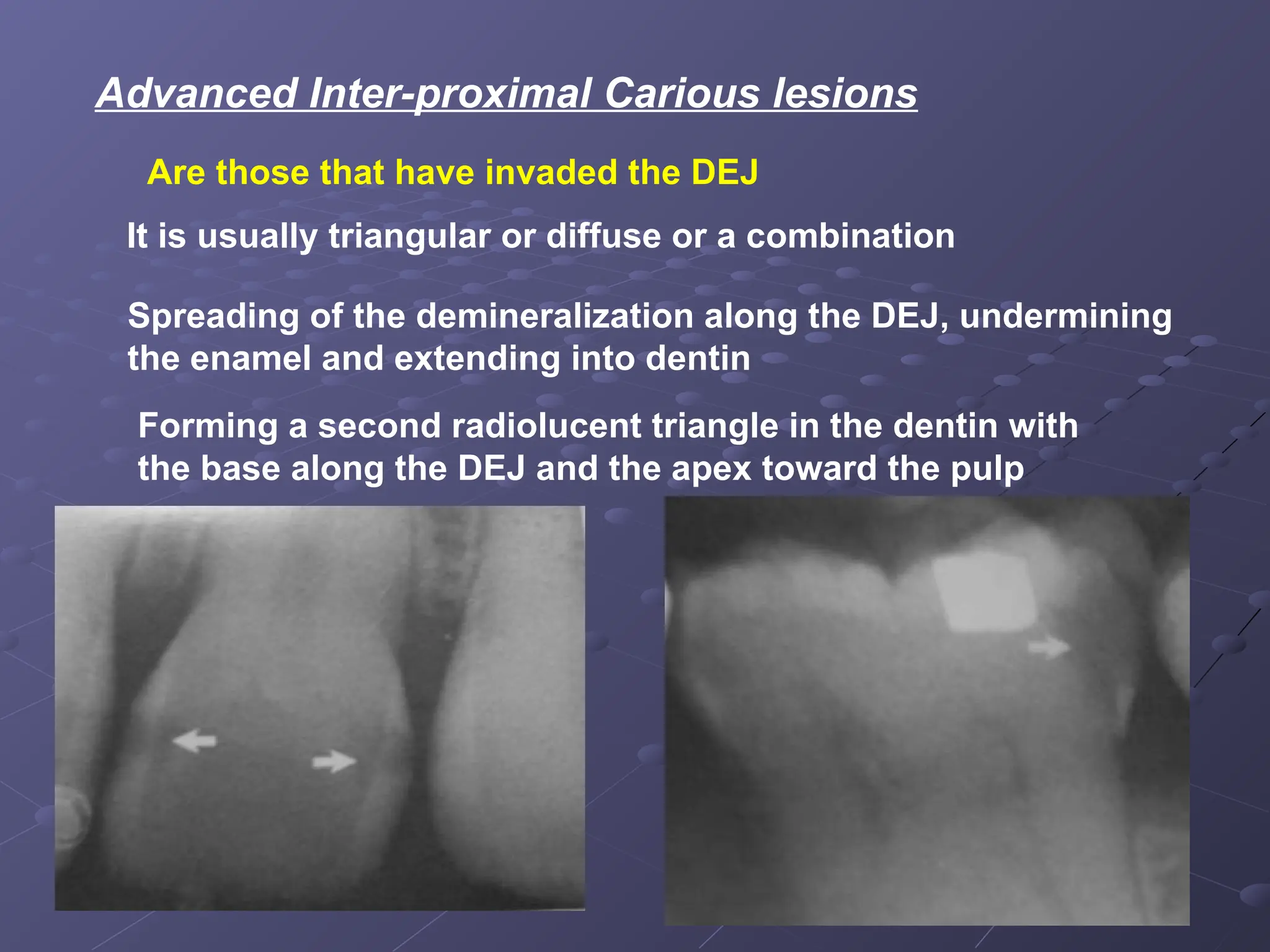 5-Dental Caries radiology in dentistry . | PPTX
