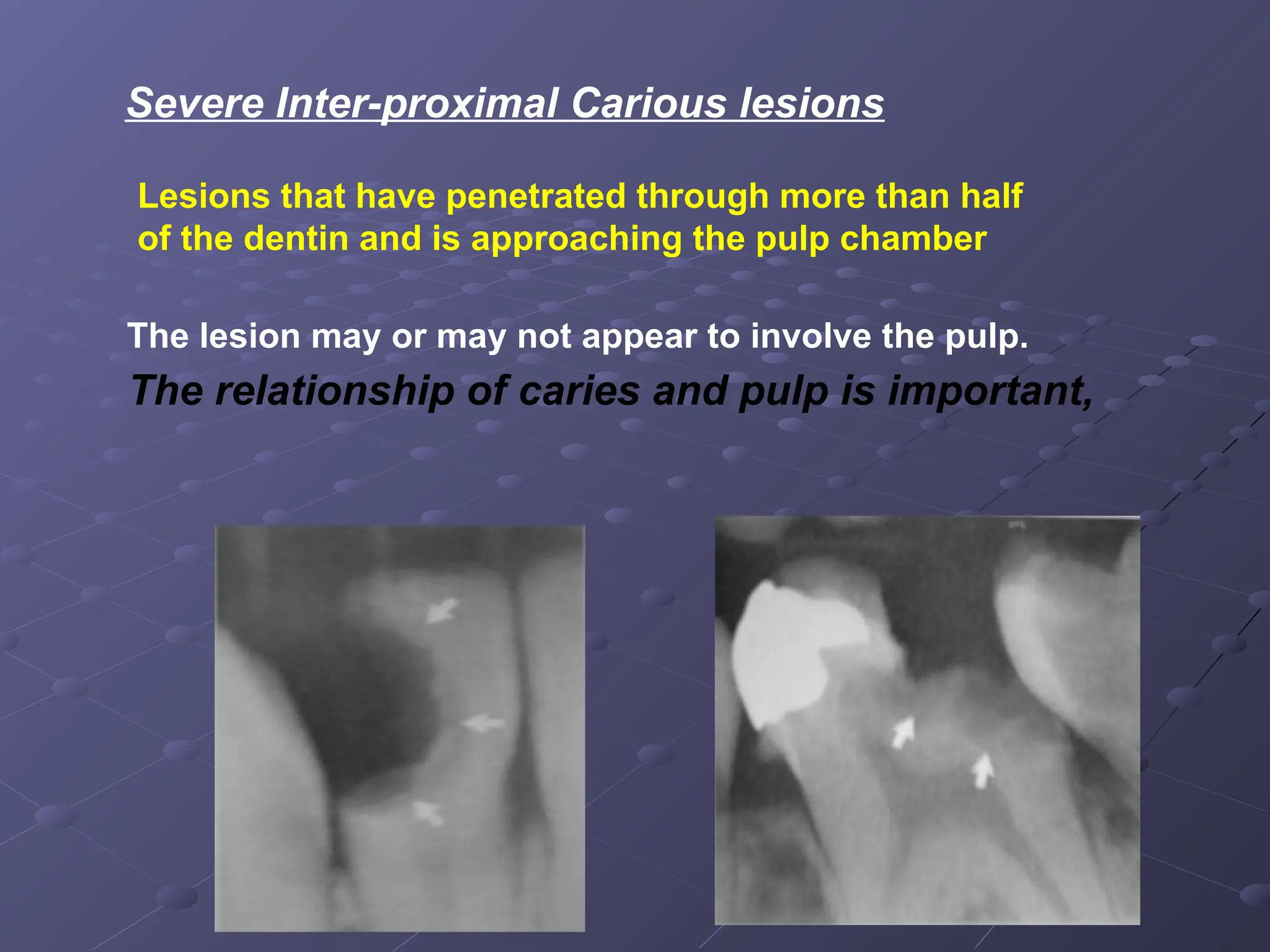 5-Dental Caries radiology in dentistry . | PPTX