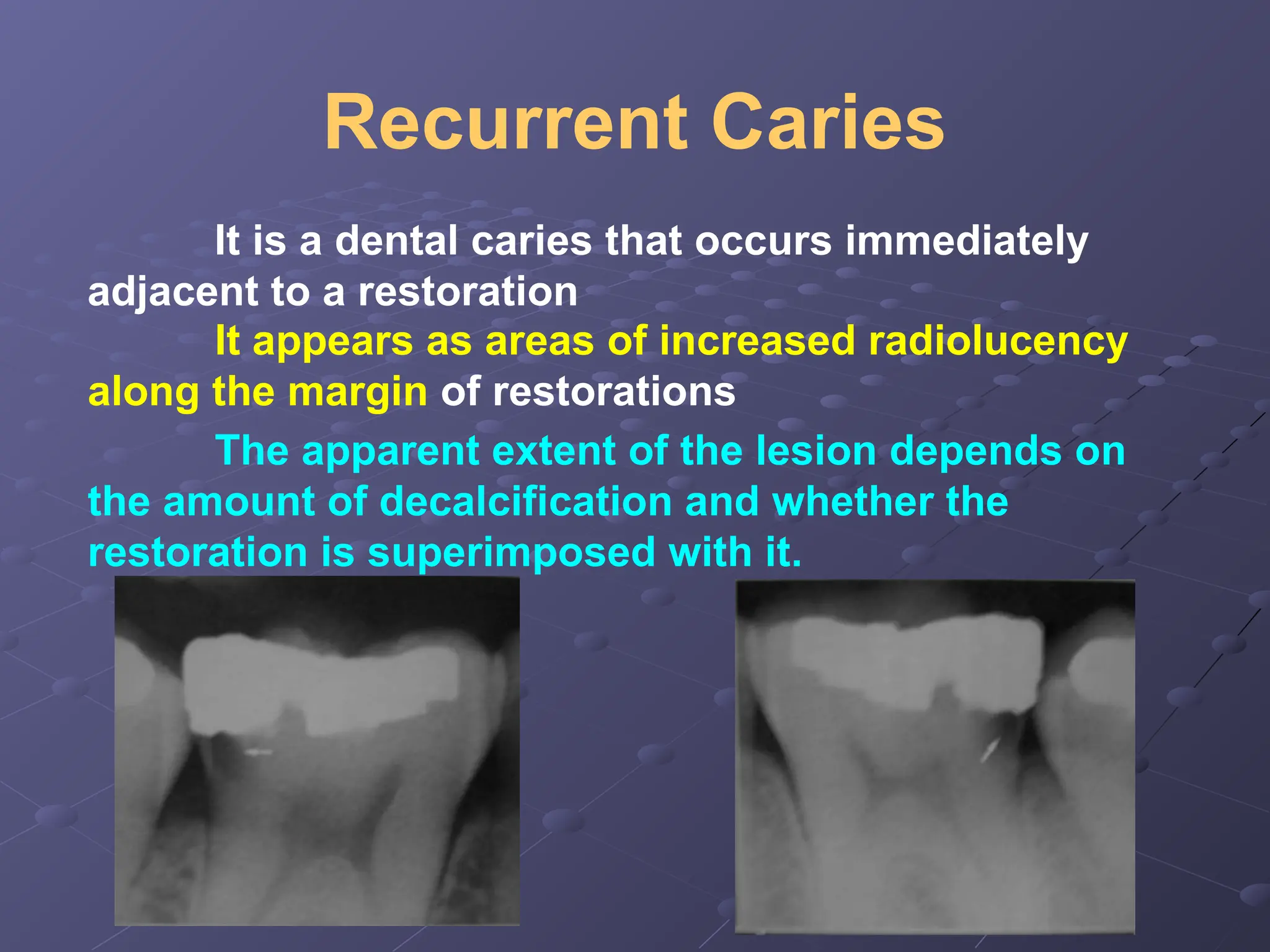 5-Dental Caries radiology in dentistry . | PPTX