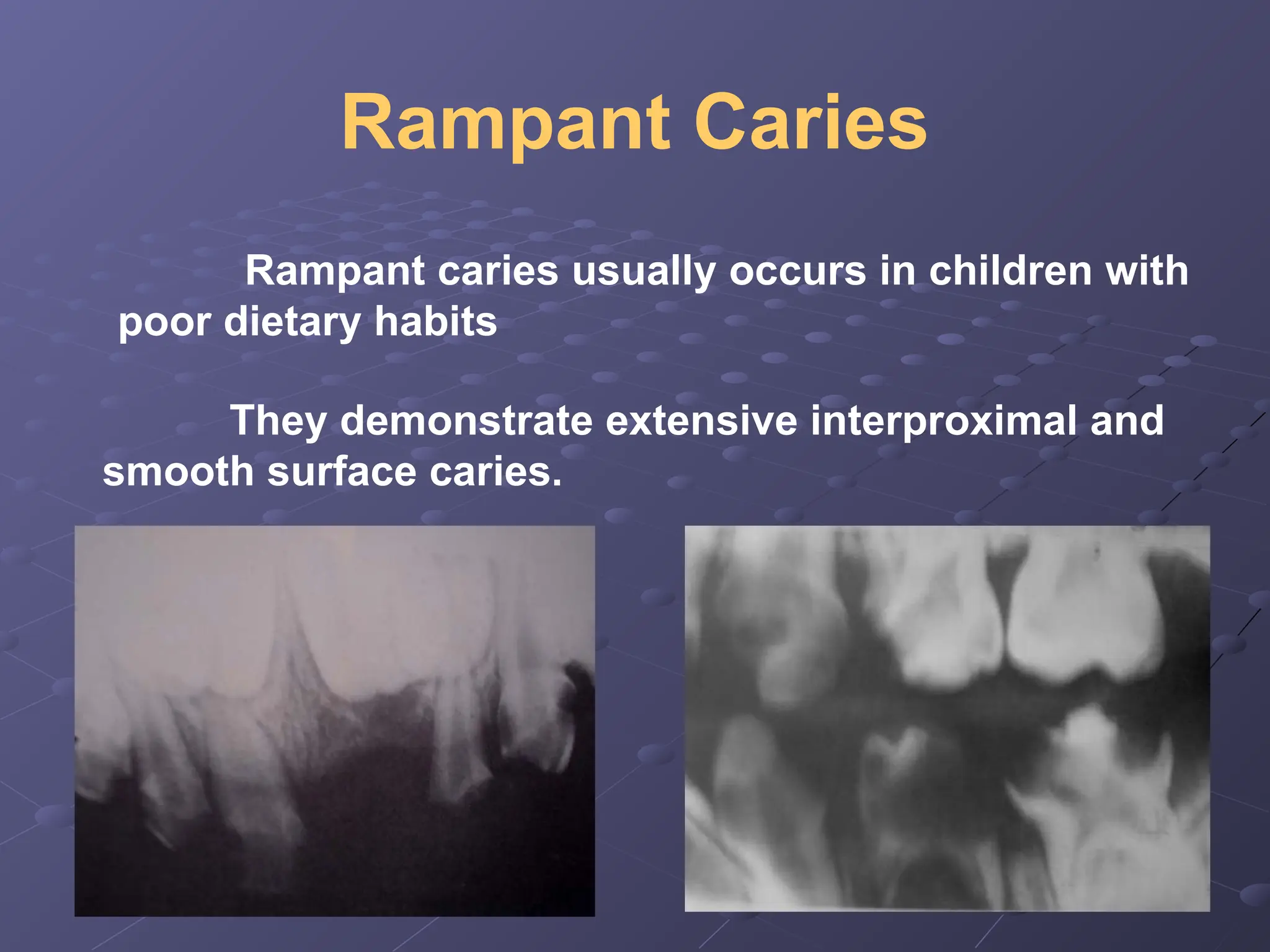 5-Dental Caries radiology in dentistry . | PPTX