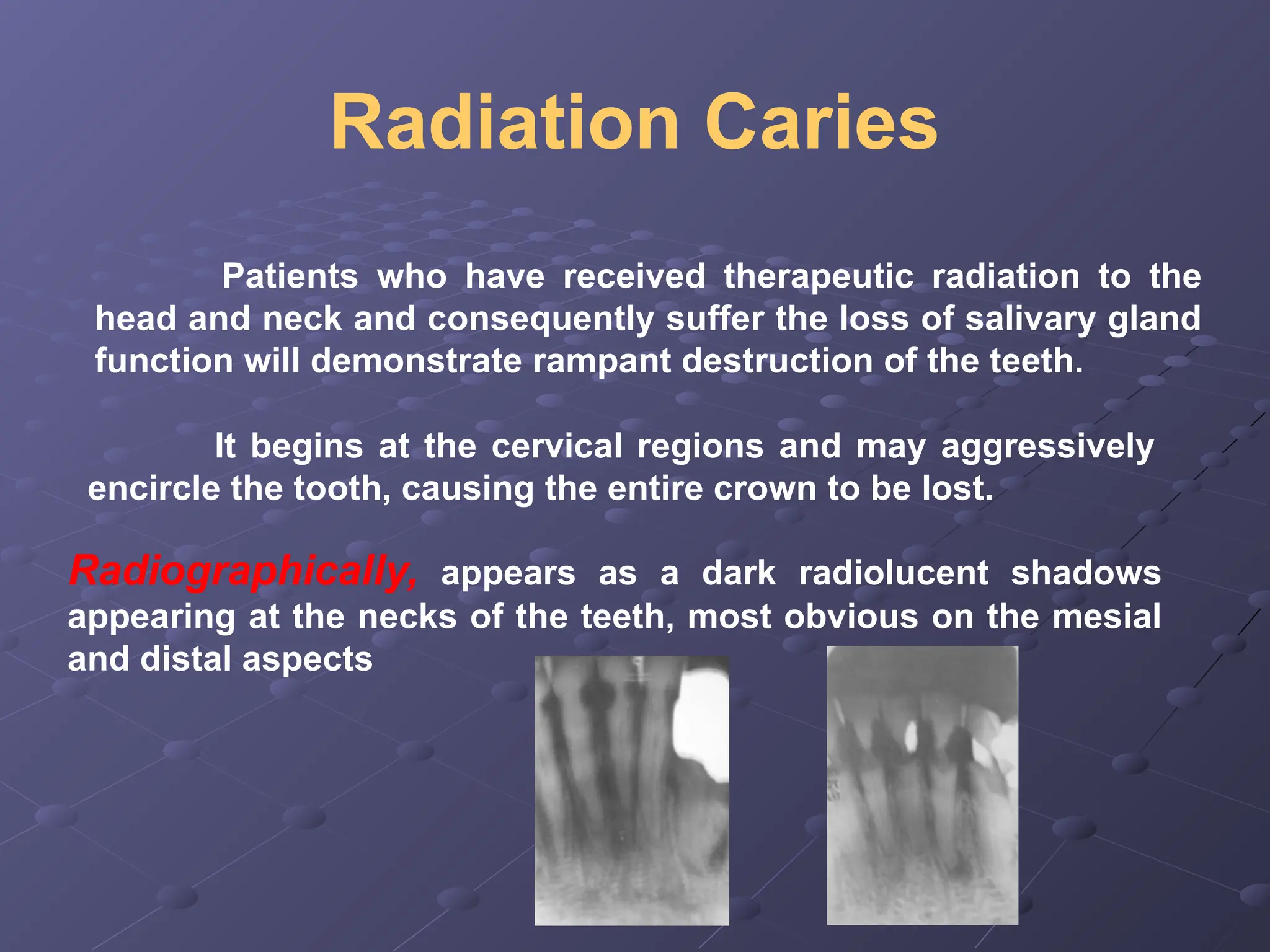 5-Dental Caries radiology in dentistry . | PPTX