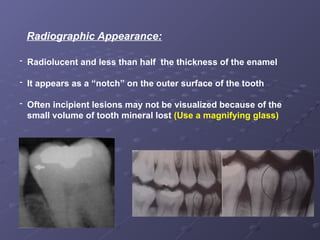 5-Dental Caries radiology in dentistry . | PPTX