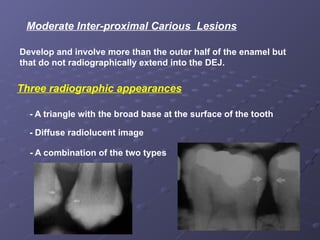 5-Dental Caries radiology in dentistry . | PPT