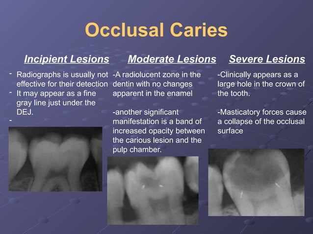5-Dental Caries radiology in dentistry . | PPT